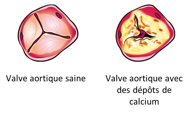 Rétrécissement aortique