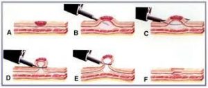 Mucosectomie (EMR) et Dissection sous-muqueuse (ESD)