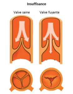 Maladies des valves cardiaques